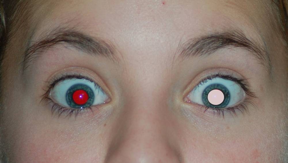 Hvit pupill på barn kan være svulst – NRK Nyttig – Tips, råd og innsikt