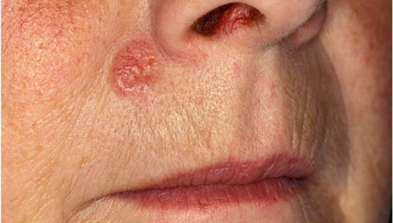 Minst 20.000 får denne «ufarlige» hudkrefttypen hvert år – NRK Nyttig ...