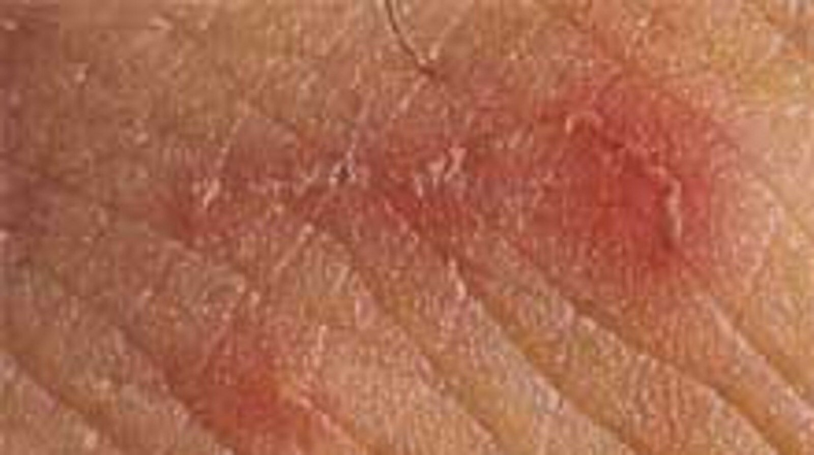 Skabb-epidemi blant unge i Oslo: – Kan ikke huske lignende – NRK Norge ...