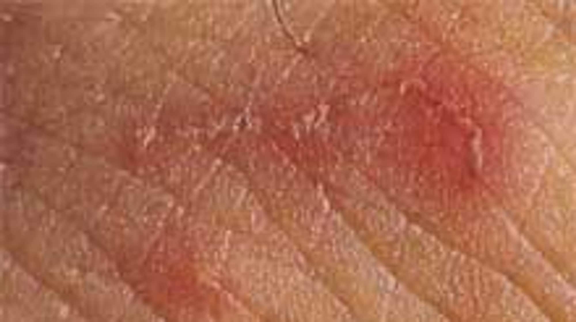 Skabb-epidemi blant unge i Oslo: – Kan ikke huske lignende – NRK Norge ...