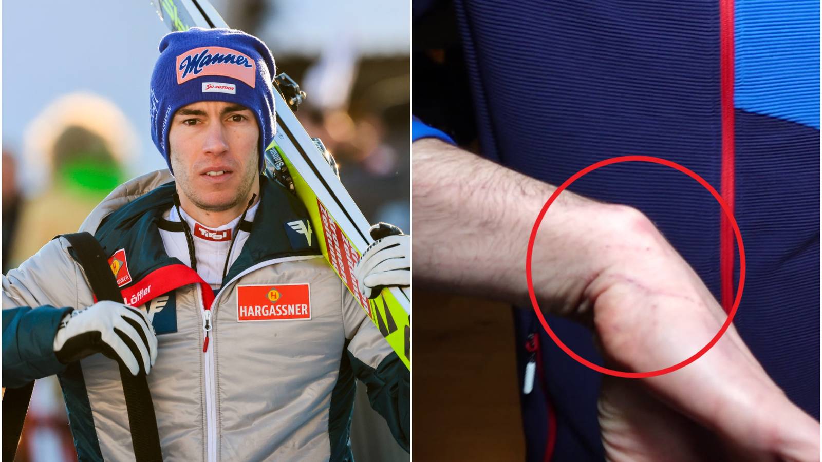 Ski-VM: VM-favoritt Stefan Kraft ble angrepet av katt: – Jeg ble forbanna – Ski-VM 2025