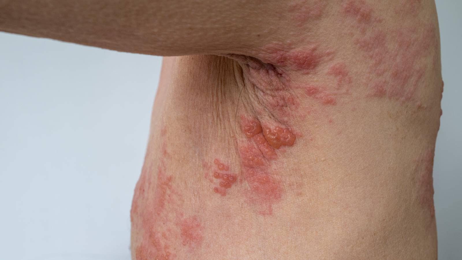 Helvetesild rammer voksne - vaksinen Shingrix kan havne på blå resept ...