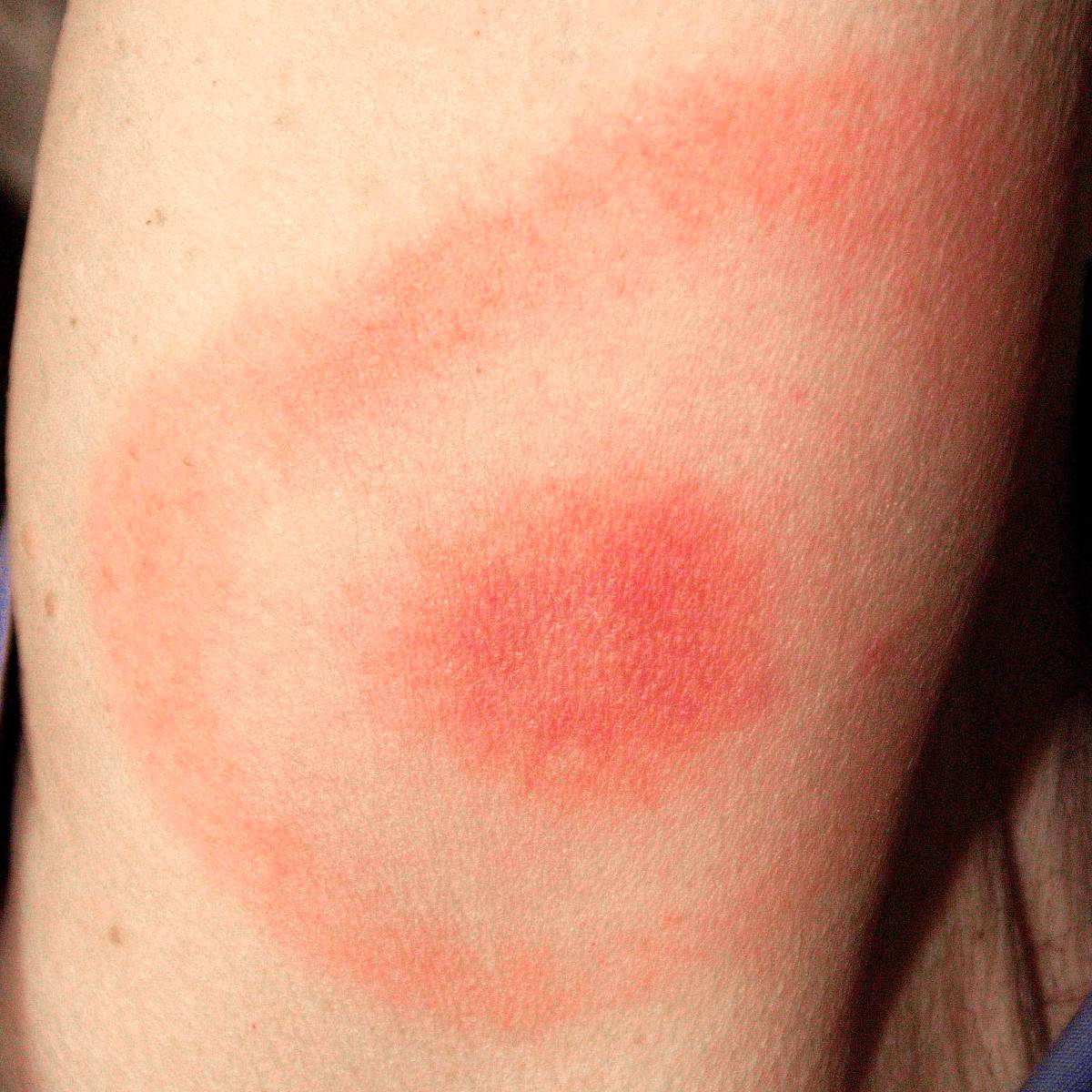 Dette bør du gjøre ved flåttbitt – NRK Nyttig – Tips, råd og innsikt