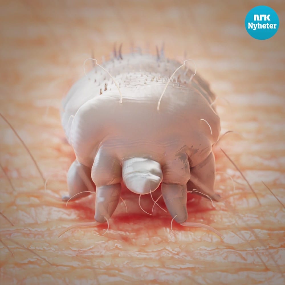 Skabb-epidemi blant unge i Oslo: – Kan ikke huske lignende – NRK Norge ...