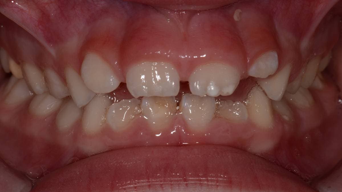 Mange barn har tenner som nesten ramler fra hverandre – forskere finner ...