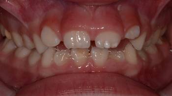 Mange barn har tenner som nesten ramler fra hverandre – forskere finner ...