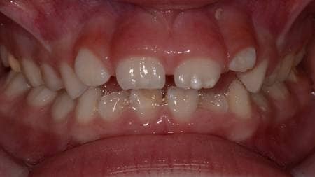 Mange barn har tenner som nesten ramler fra hverandre – forskere finner ...