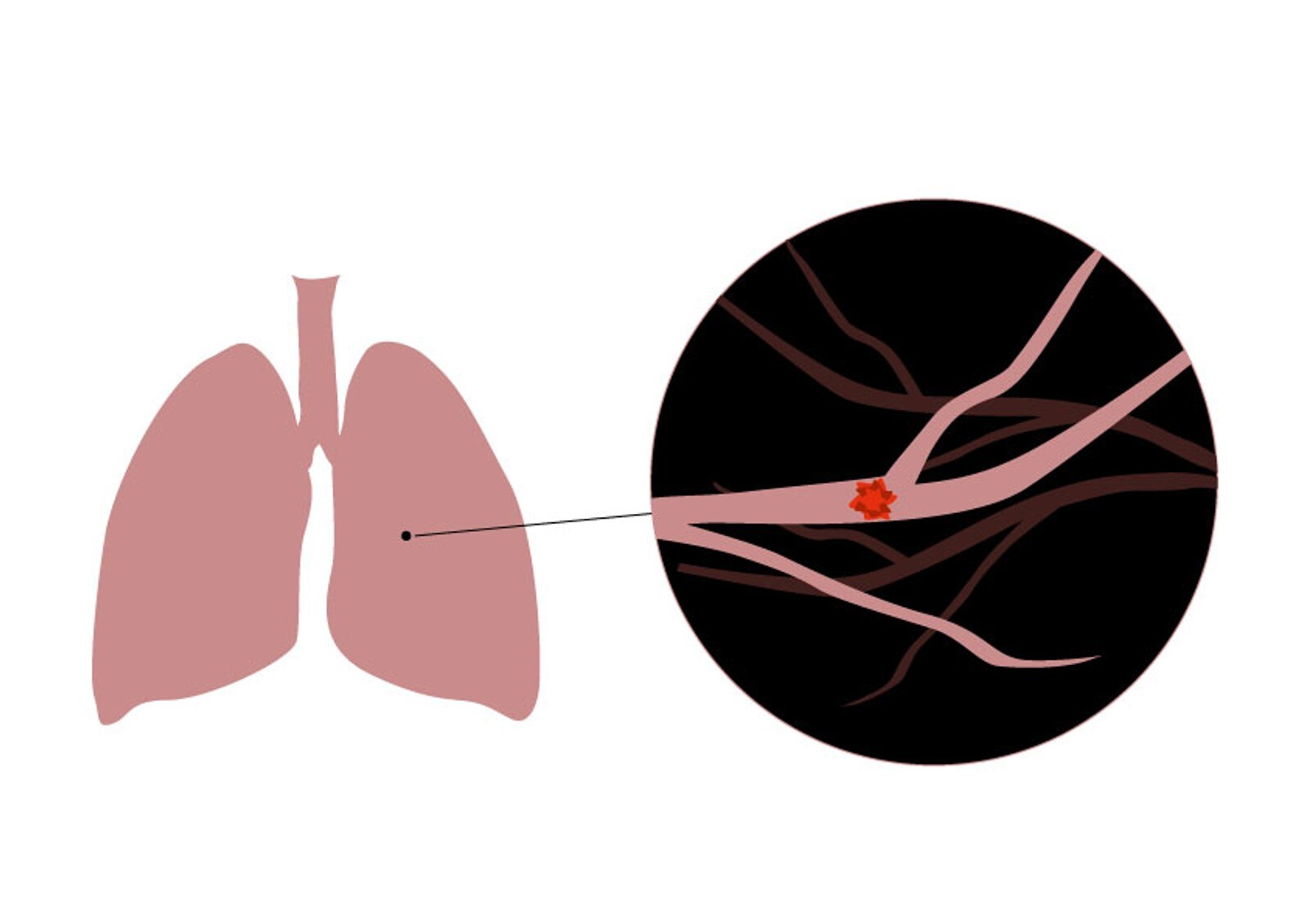 Fikk blodpropp i lungene av p-piller – Langlesing fra Trøndelag