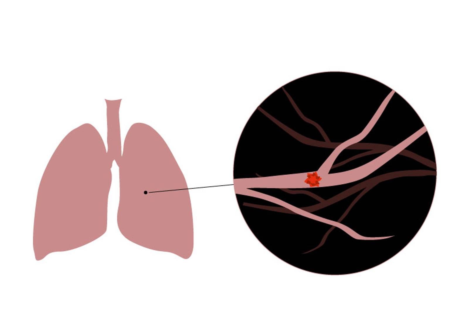 Fikk blodpropp i lungene av p-piller – Langlesing fra NRK Trøndelag