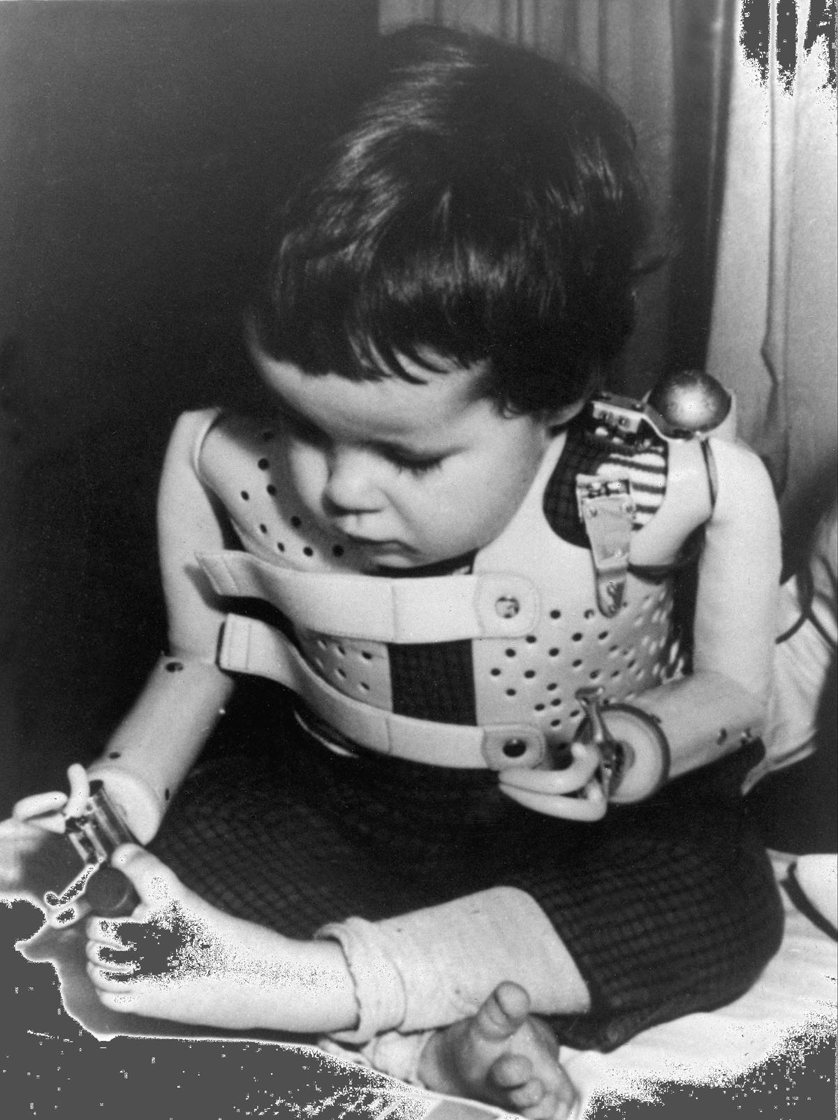 «Thalidomid-barn» tilbake i Brasil – NRK Nyttig – Tips, råd og innsikt