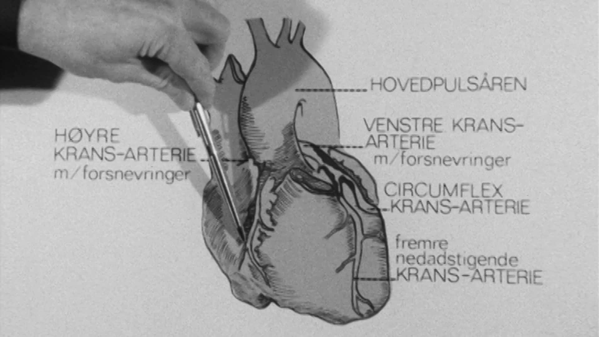 Om hjerteinfarkt - NRK TV