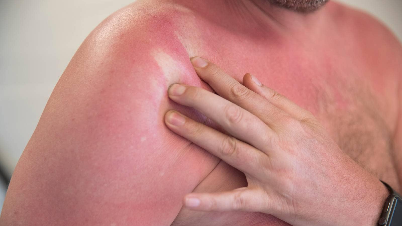 Økning i føflekkreft: – Du må ikke bli lurt av en høy solfaktor – NRK Sørlandet – Lokale nyheter ...