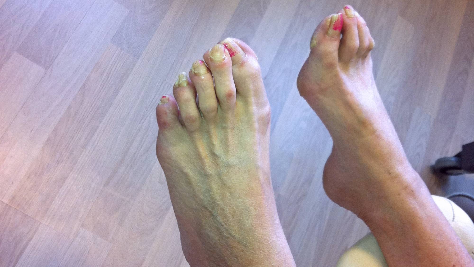 Høye sko kan gi store plager – NRK Nyttig – Tips, råd og innsikt