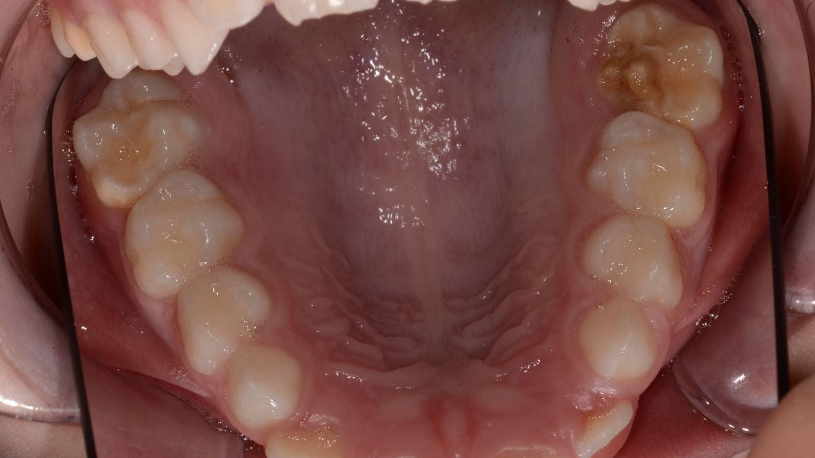 Mange barn har tenner som nesten ramler fra hverandre – forskere finner ...