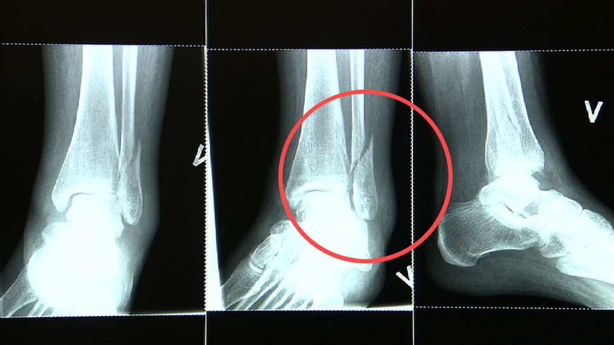 Uvanlig mange beinbrudd før jul – NRK Østfold – Lokale nyheter, TV og radio