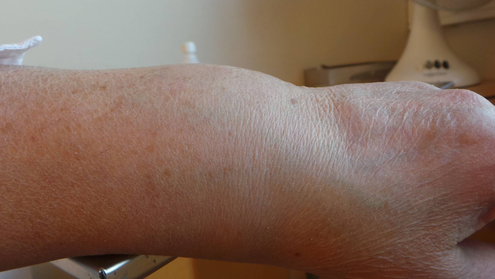 Ny medisin kan hemme leddgikt – NRK Vestfold og Telemark – Lokale ...