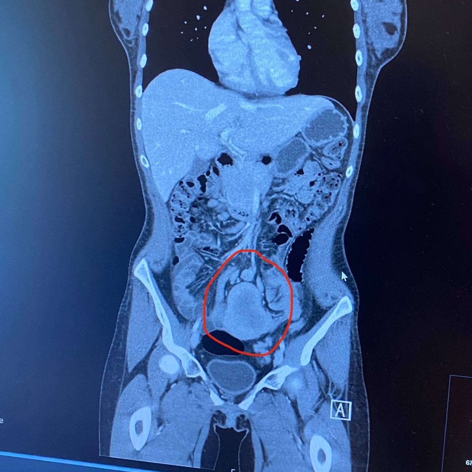 Iselin slo seg aldri til ro med at ho berre hadde fødselsplager – NRK ...