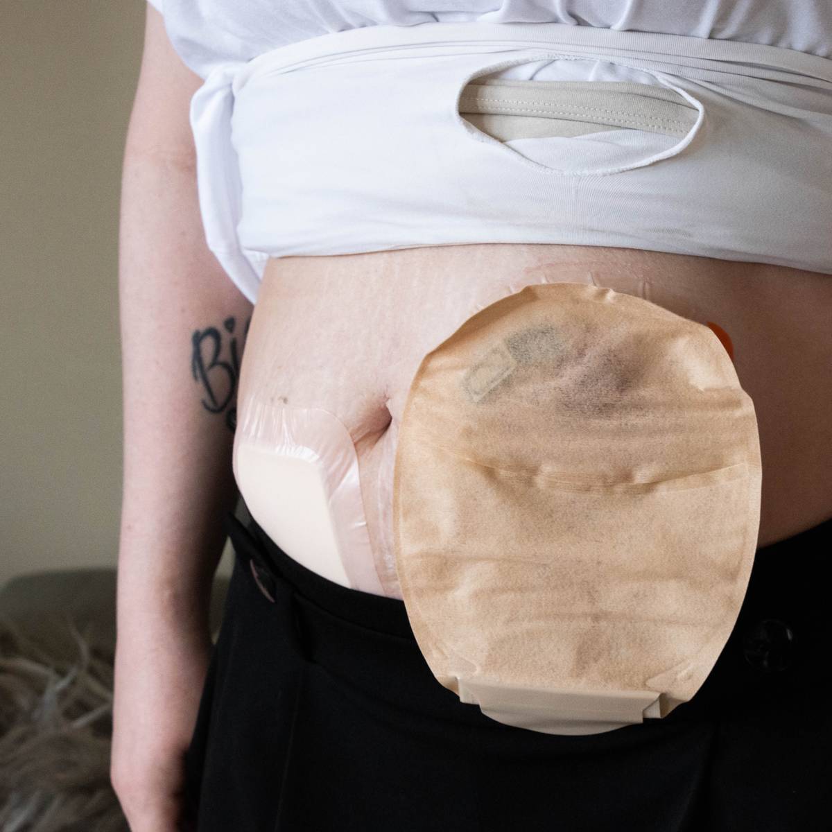 67 prosent med utlagt tarm har opplevd lekkasje frå stomiposen – NRK ...