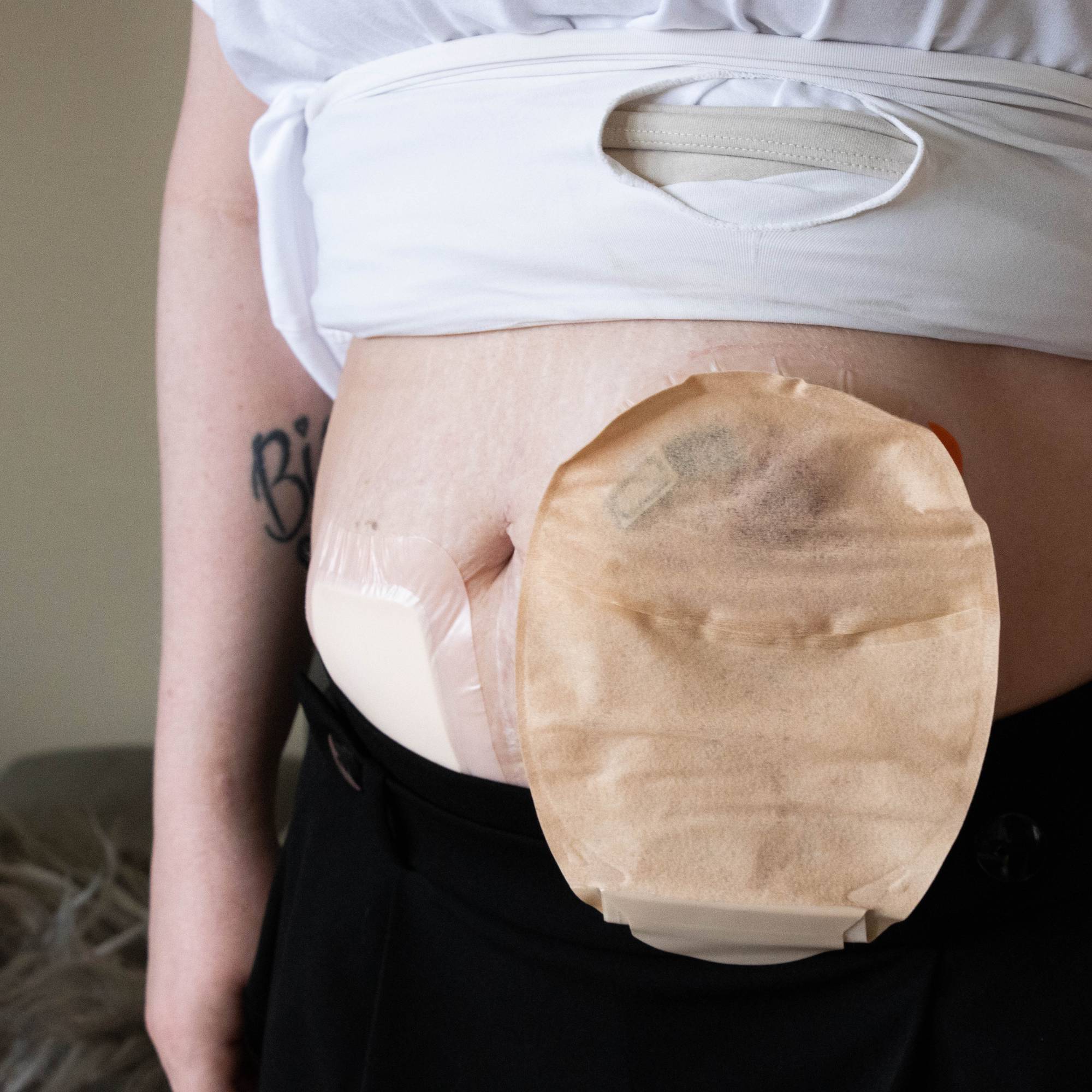 67 prosent med utlagt tarm har opplevd lekkasje frå stomiposen – NRK ...