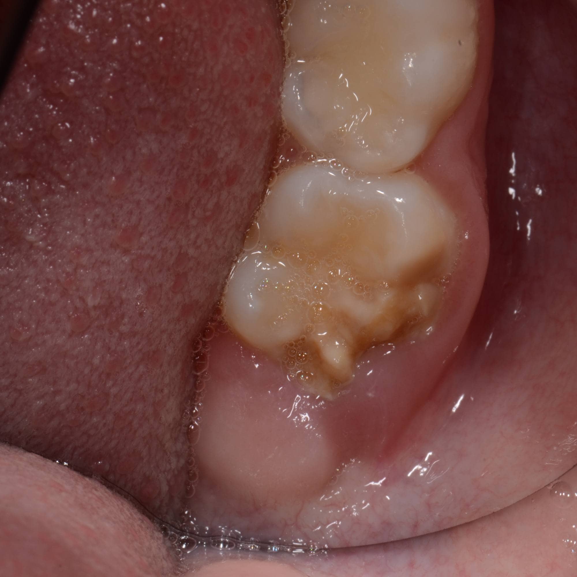 Mange barn har tenner som nesten ramler fra hverandre – forskere finner ...