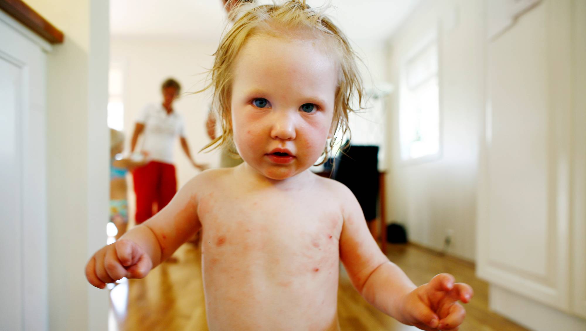 Matallergi kan oppstå via huden – NRK Viten – Nyheter innen vitenskap ...