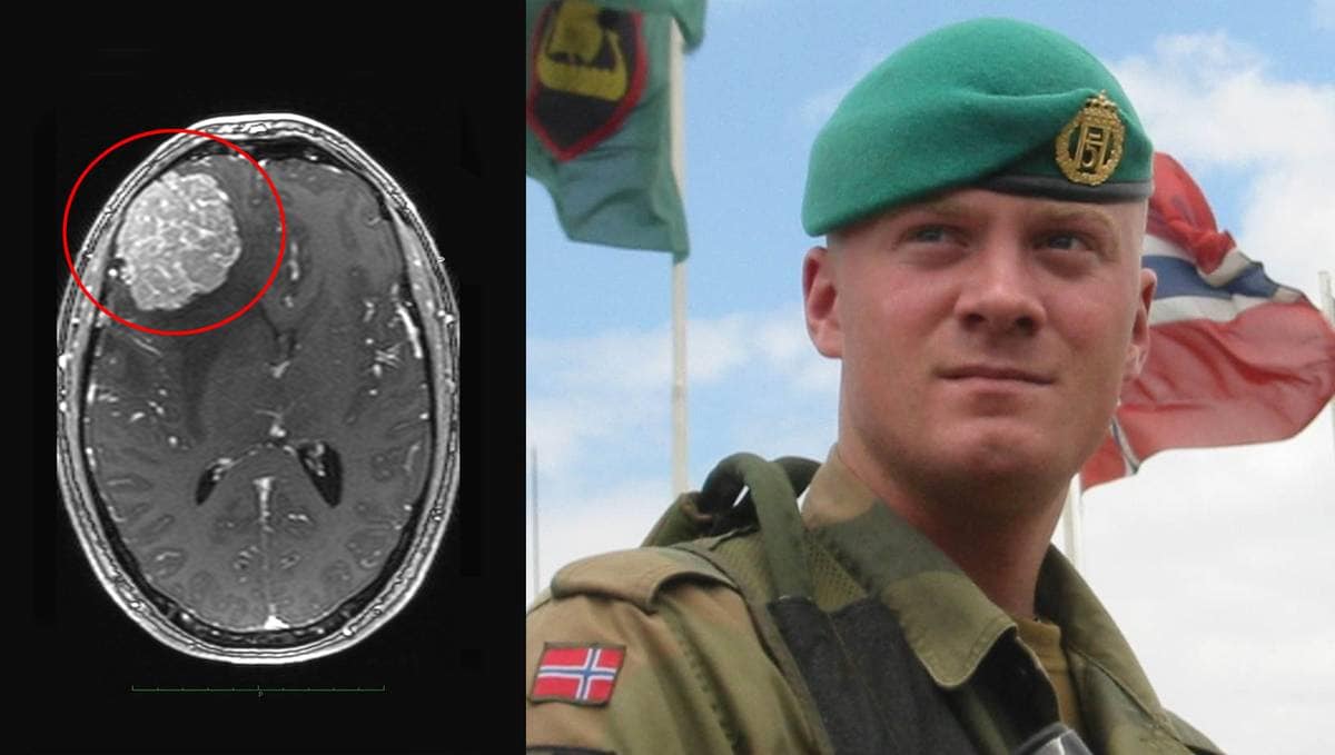 Kosovo-soldat fekk hjernesvulst – NRK Vestland