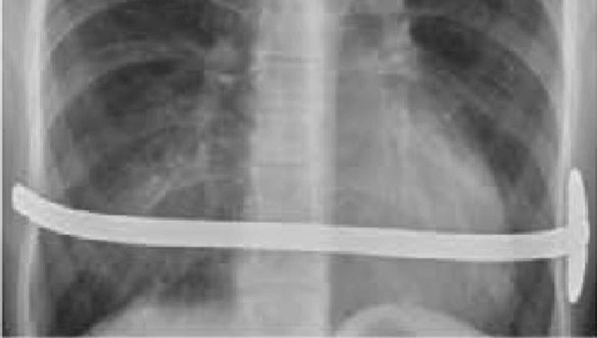 Gutter står i kø for å operere brystkassa – NRK Norge – Oversikt over ...